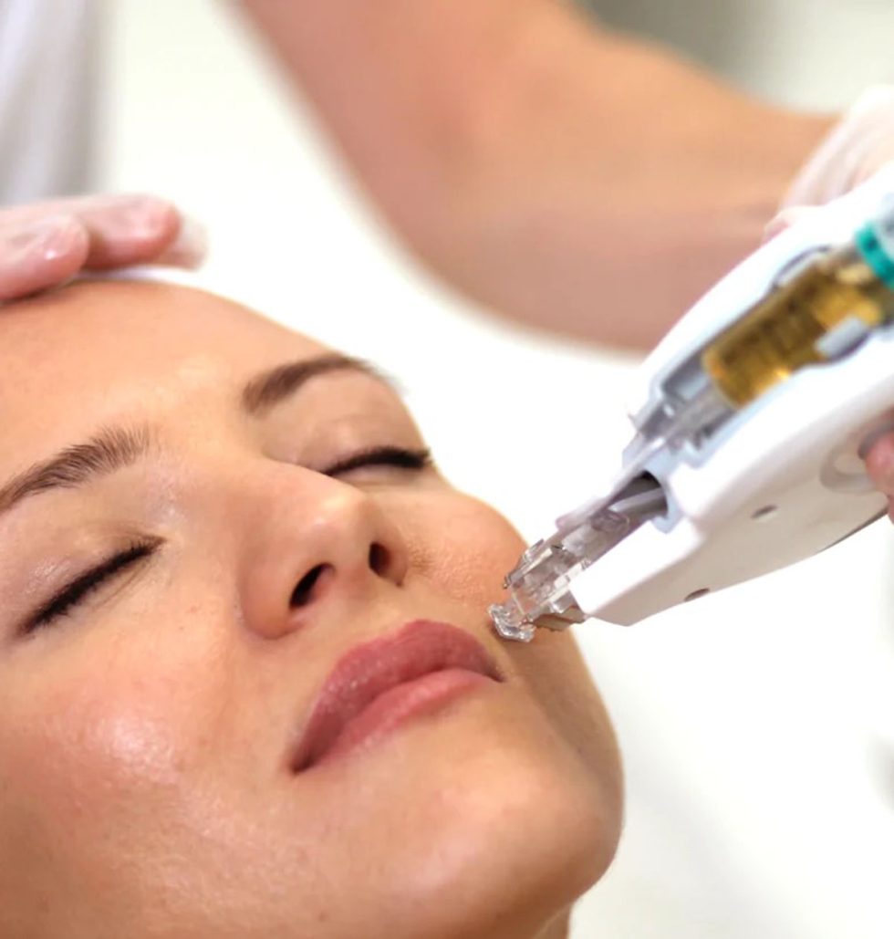 Mesotherapy Treatment - Young and Beautiful Salon Spa